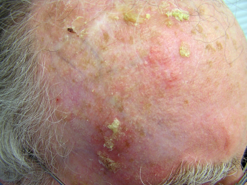 Actinic Keratosis Pictures And Photos Actinic Keratosis Pictures And Photos